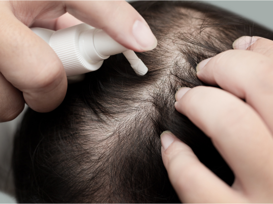 Alopécie androgénétique masculine | Alopexy